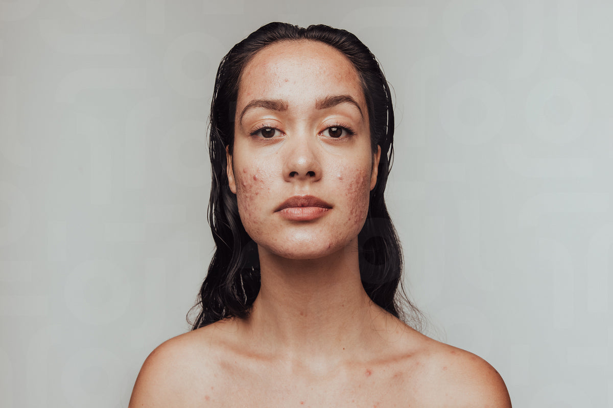 Portrait of woman having skin problems – Jacob Lund Photography Store ...